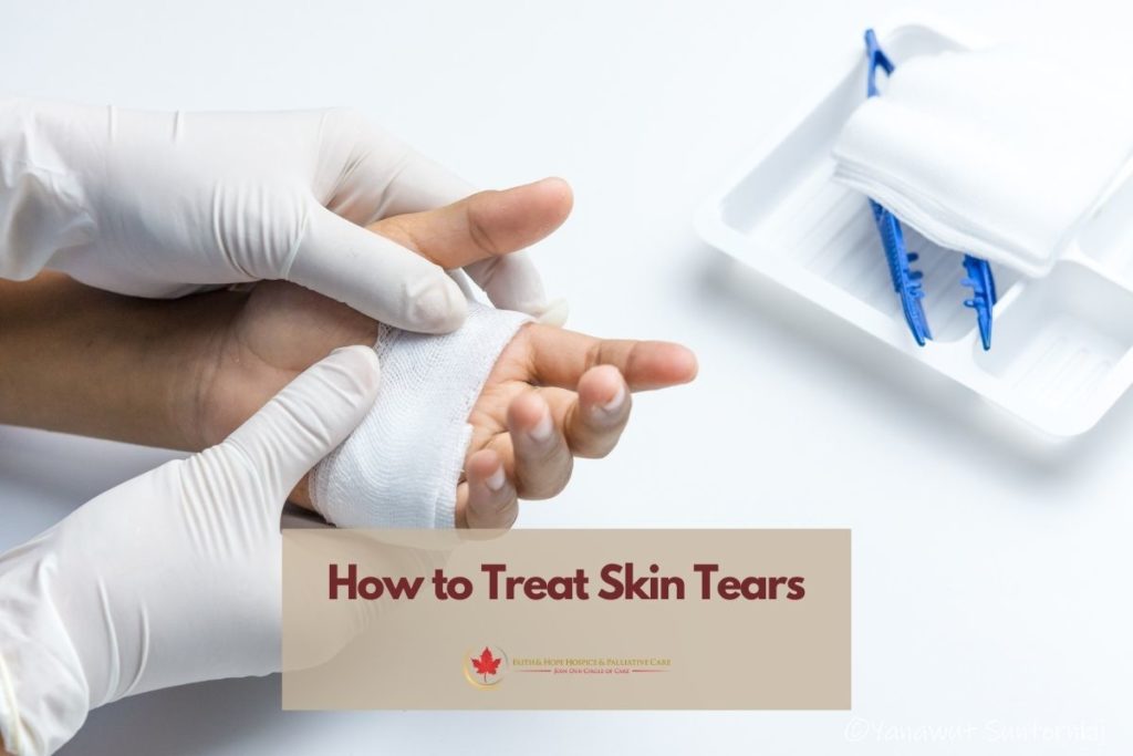 How to Treat Skin Tears